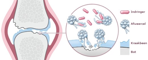 Reumatoïde artritis (RA)